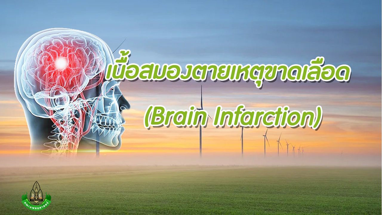 เนื้อสมองตายเหตุขาดเลือด (Brain Infarction) | โรงพยาบาลศรีนครินทร์ คณะ ...